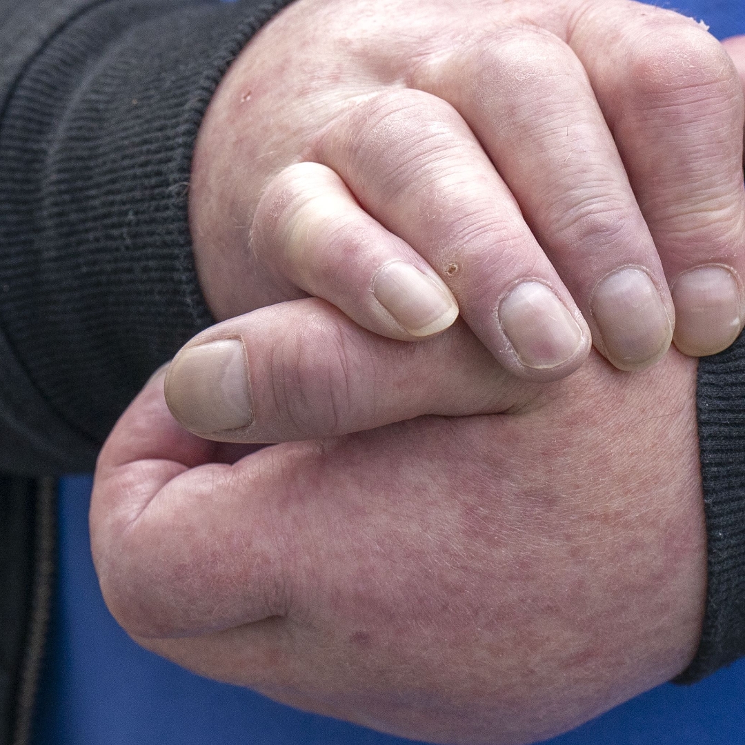 Man has double hand transplant in ‘world first’ for scleroderma patient